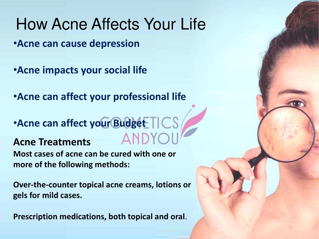 How Acne Affects Your Life – Cosmetics and you : Acne Treatment ...