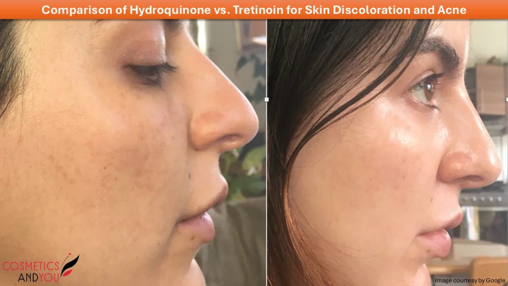 Comparison of Hydroquinone vs. Tretinoin for Skin Discoloration and ...