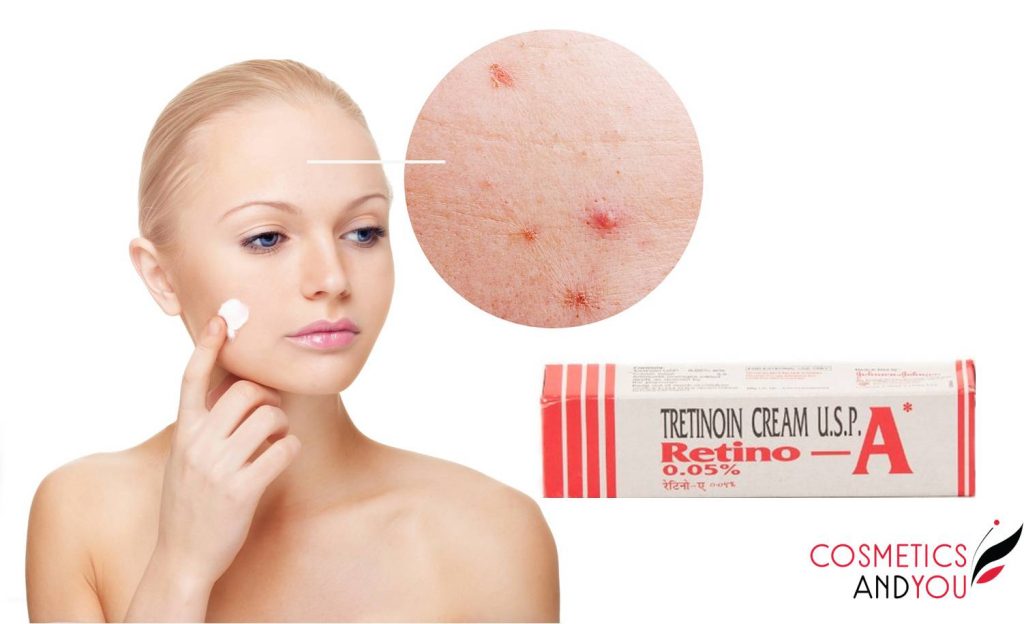 tretinoin cream 0.05 – Cosmetics and you : Acne Treatment, Careprost ...