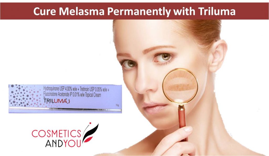 How to Cure Melasma Permanently – Cosmetics and you : Acne Treatment ...