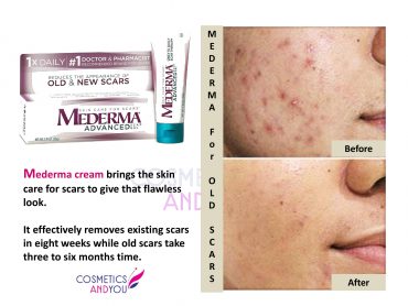 Mederma Reviews for Old Scars – Cosmetics and you : Acne Treatment ...